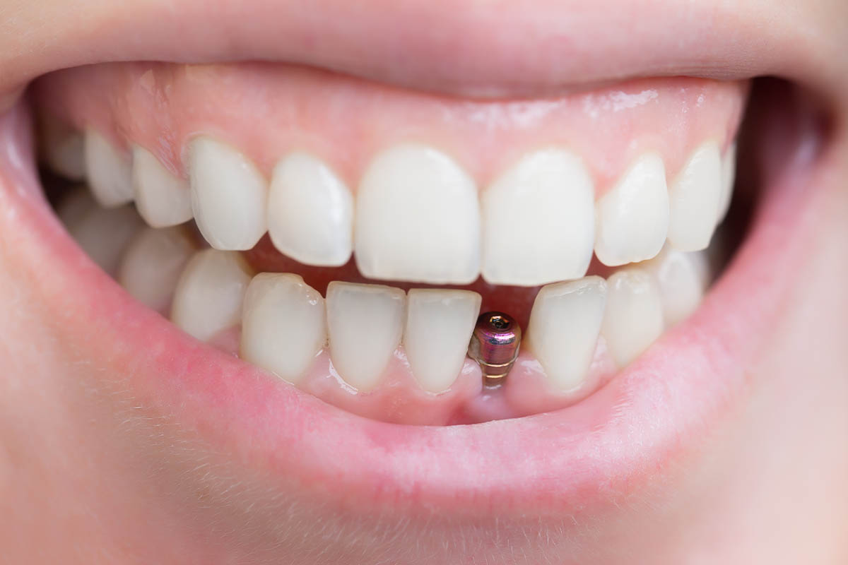 single-tooth-implant-dental-implants-dentist-cinco-ranch-texas